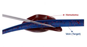 EbnetPIVC for First Puncture Success (under development)