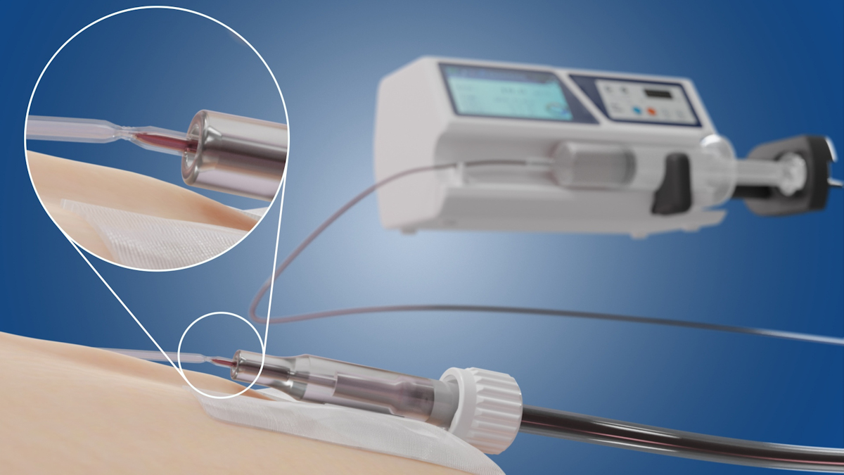Ebnet Medical - Non-Kinking Vascular Catheter for Reliable Catheter Patency