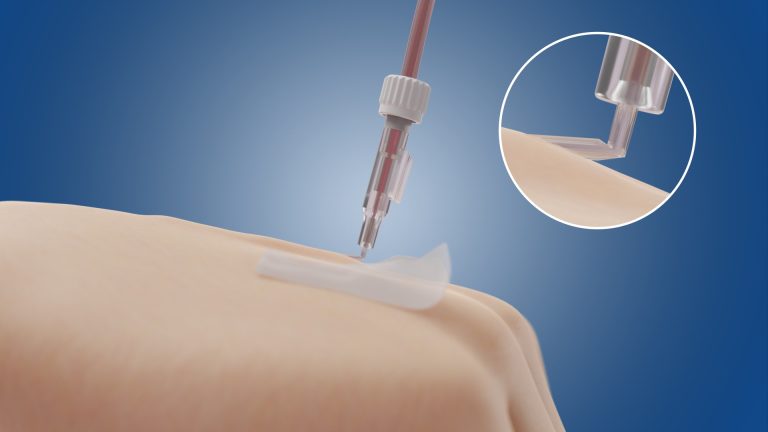 Components Catheter Fixation for Emergency Use - Ebnet Medical
